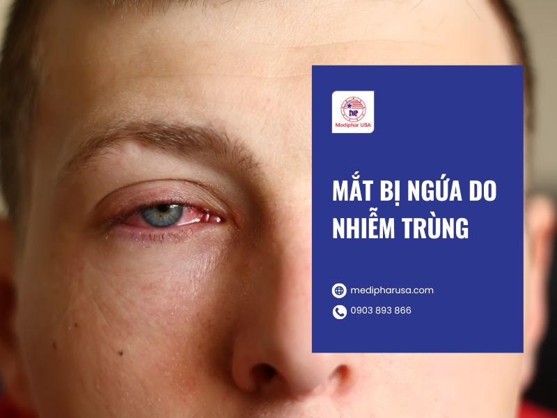 Ngứa mắt là bị gì? Nguyên nhân, dấu hiệu và cách trị