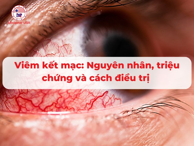 Viêm kết mạc: Nguyên nhân, triệu chứng và cách điều trị và phòng ngừa ...