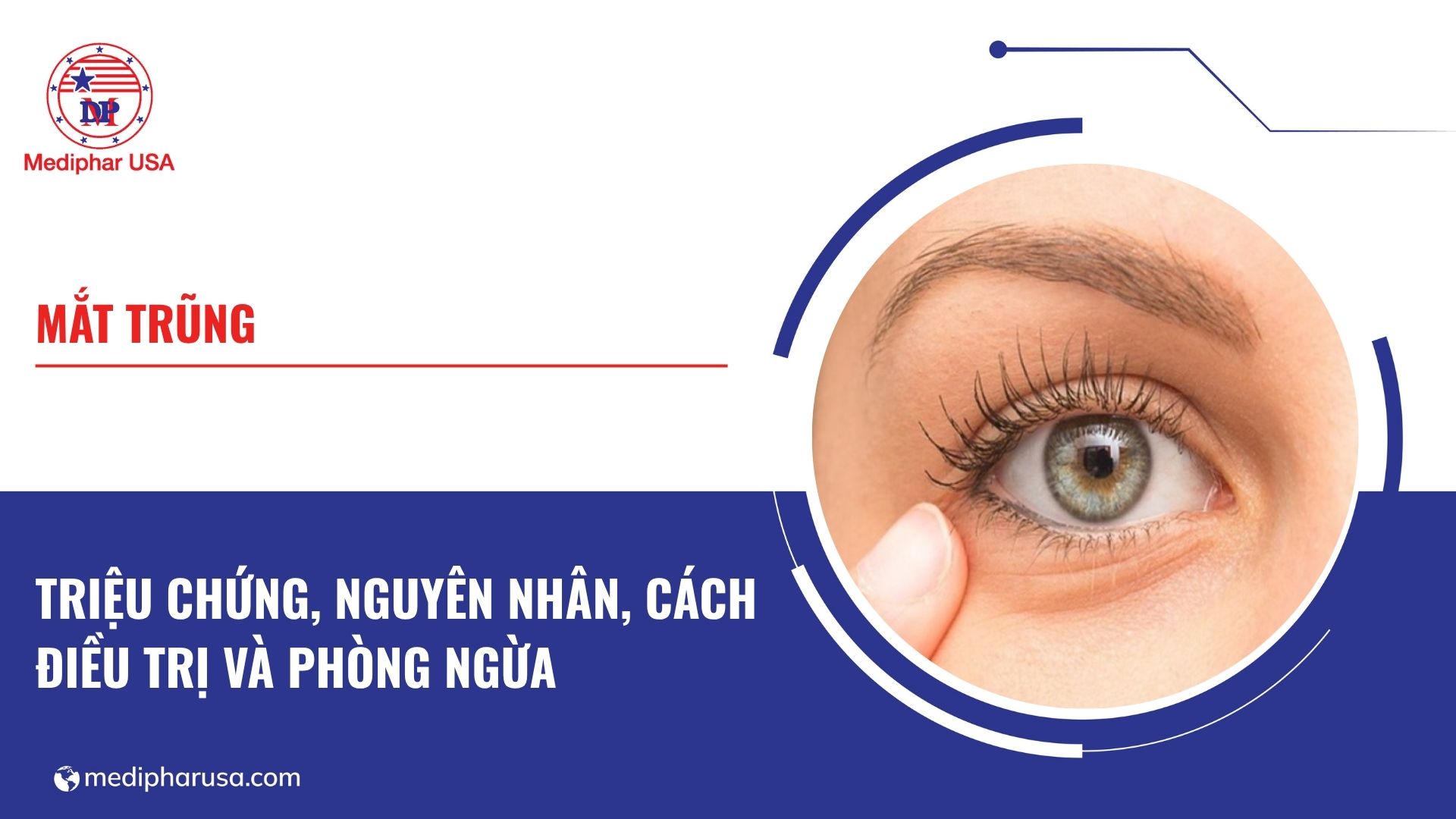 Mắt trũng là gì? Nguyên nhân, dấu hiệu và cách điều trị